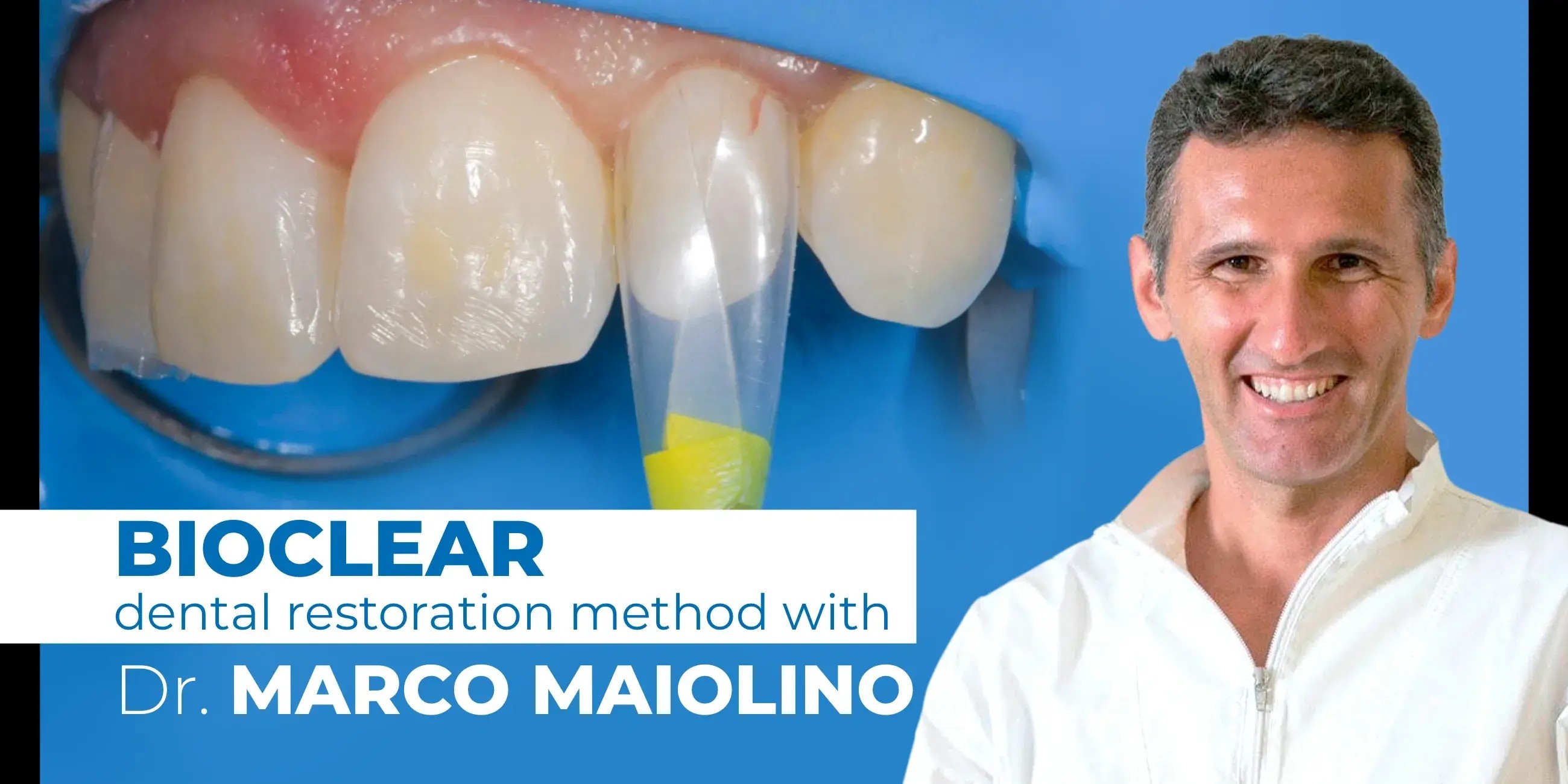 Online Course: Bioclear Composite Restorations with Dr Marco Maiolino