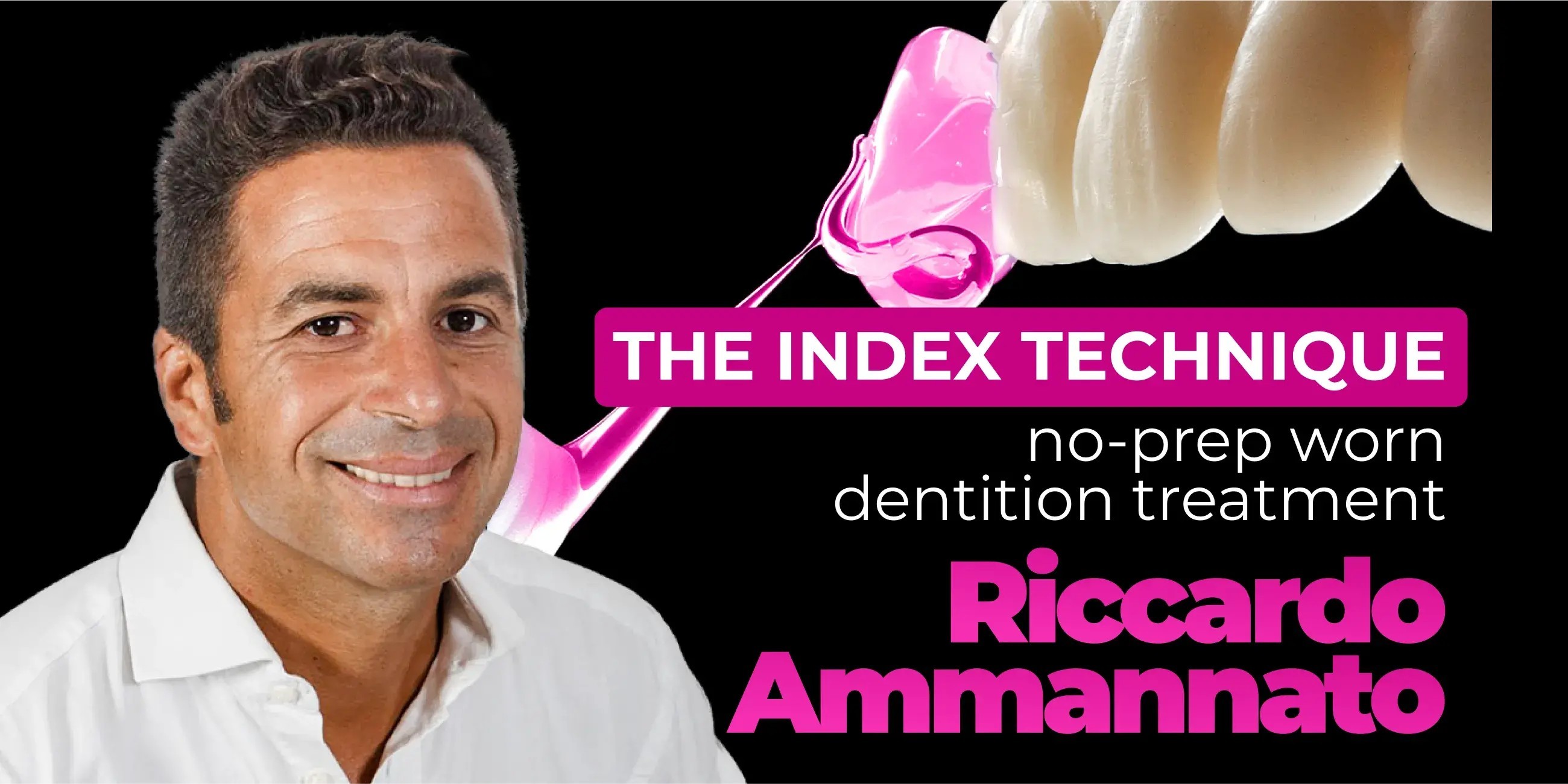 Webinar: the Index Technique, tooth wear treatment protocol