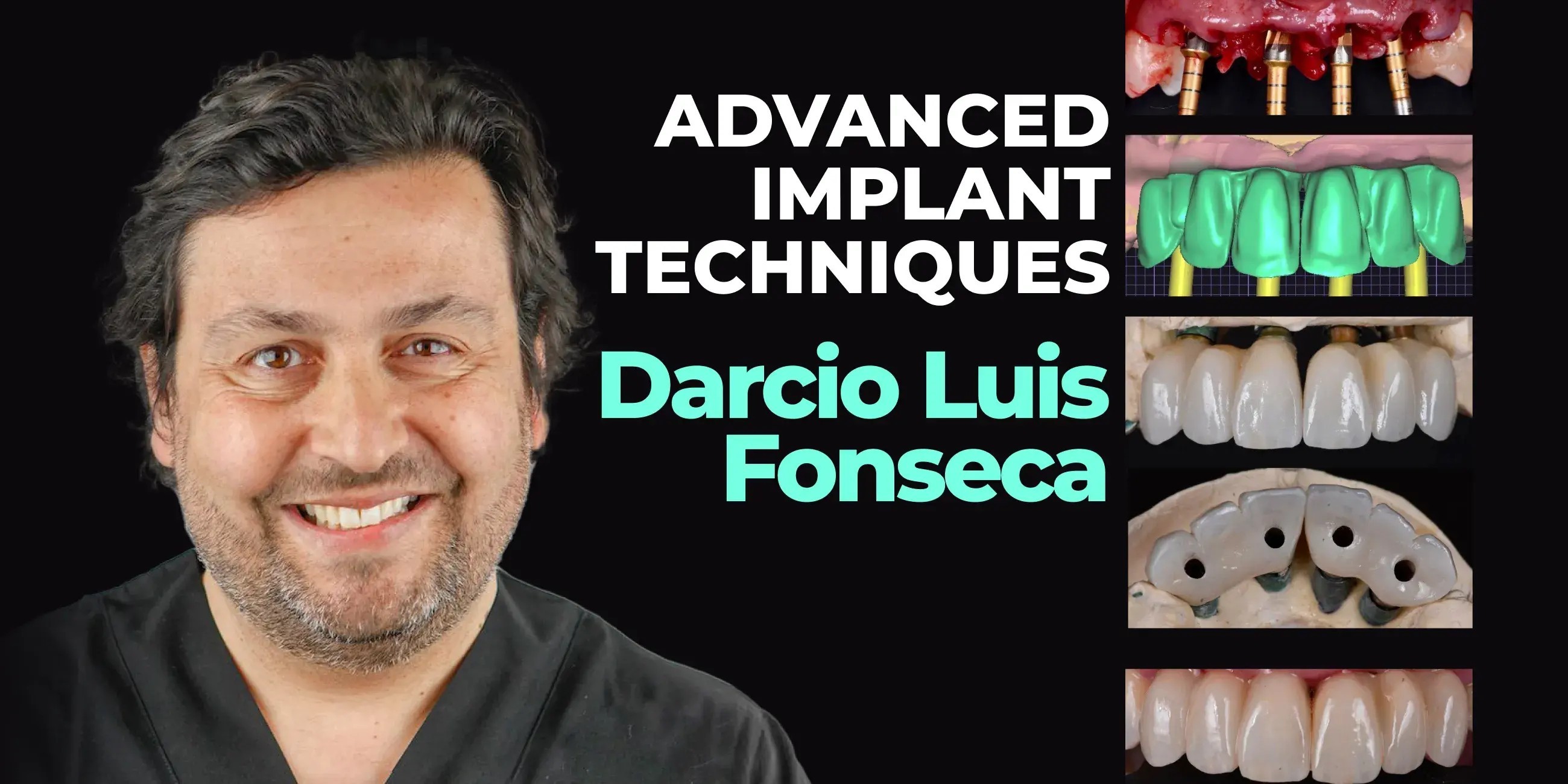 Partial Extraction Therapy: An In-Depth Analysis of the Socket-Shield ...