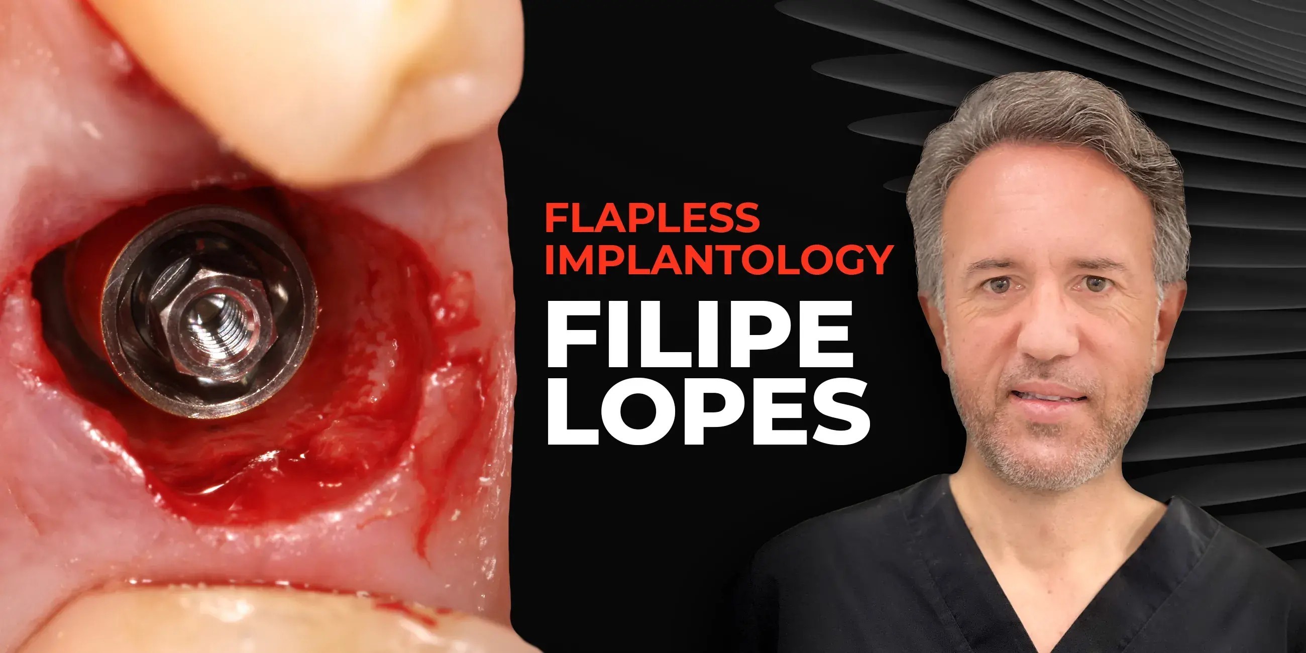 Flapless implantology: protocols for immediate implant placement and loading