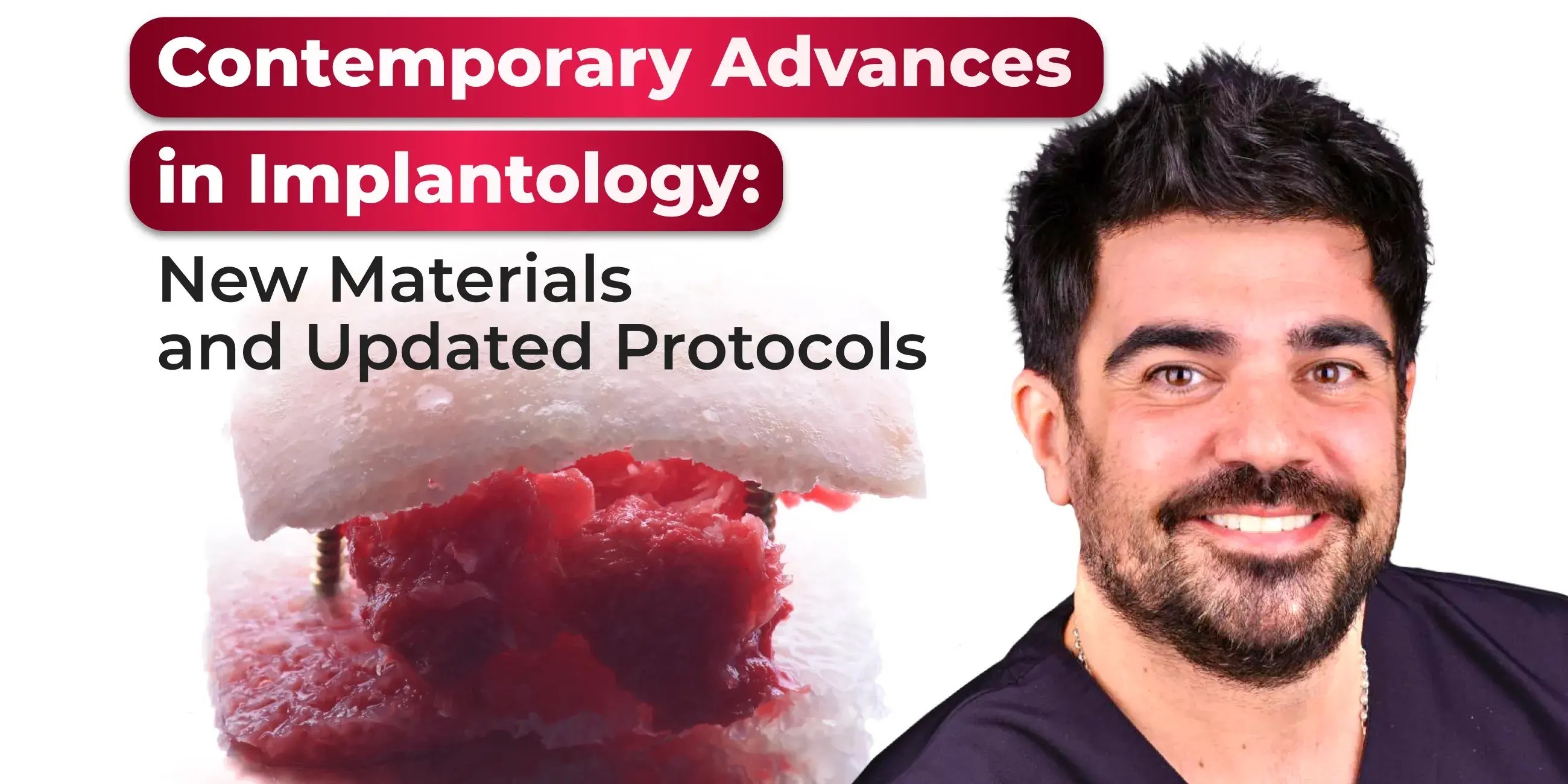Horizontal Bone Grafting with Split Crest Technique