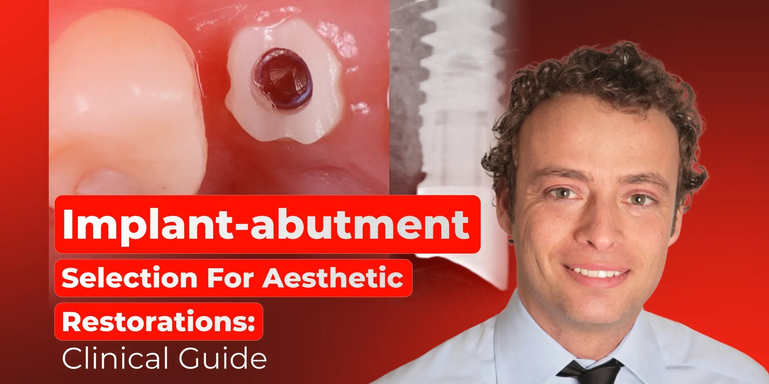Emergence Profile and Soft Tissue Management with Custom Healing Abutments