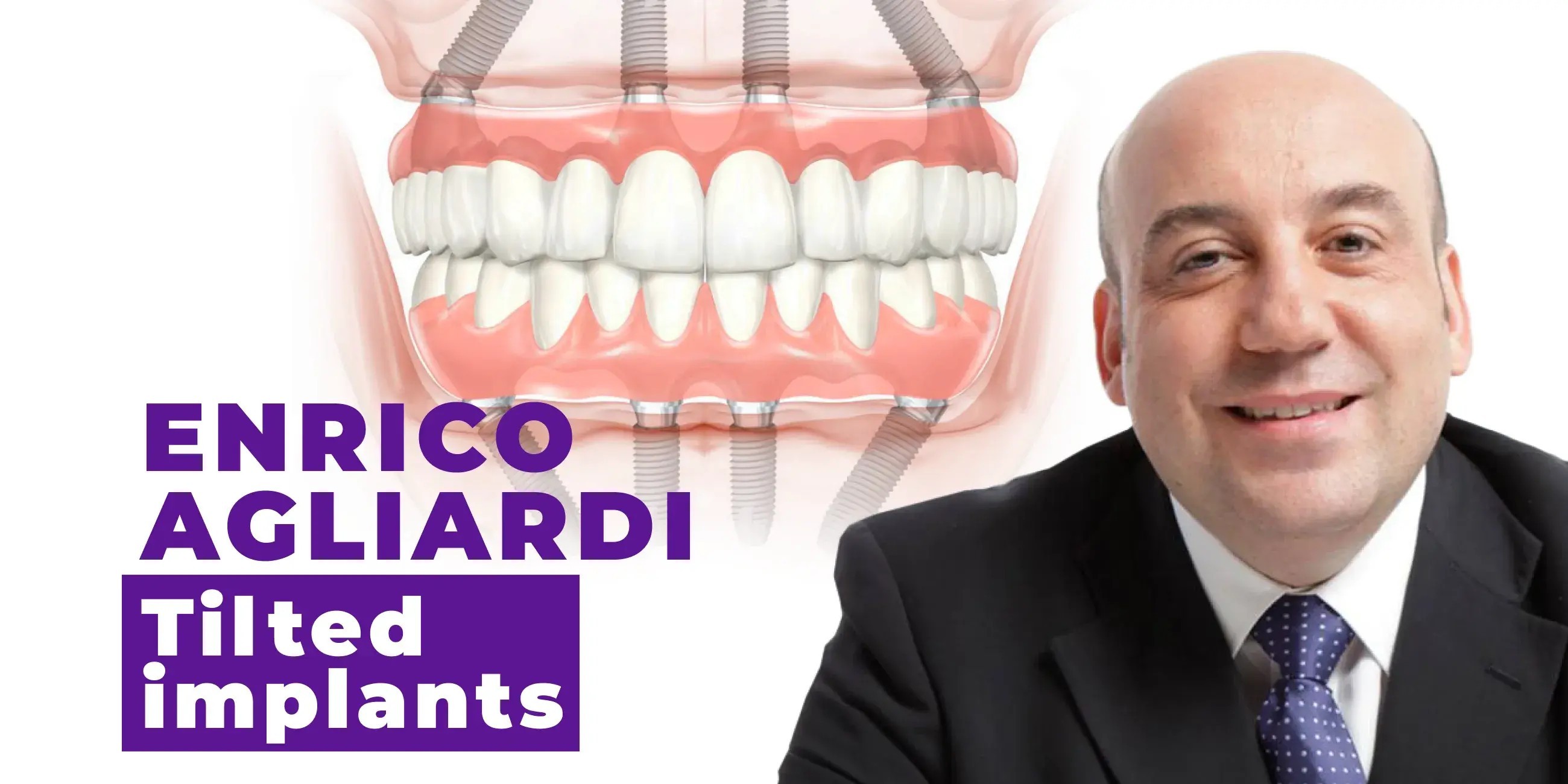 Tilted implants: treatment of single defects and full adentia