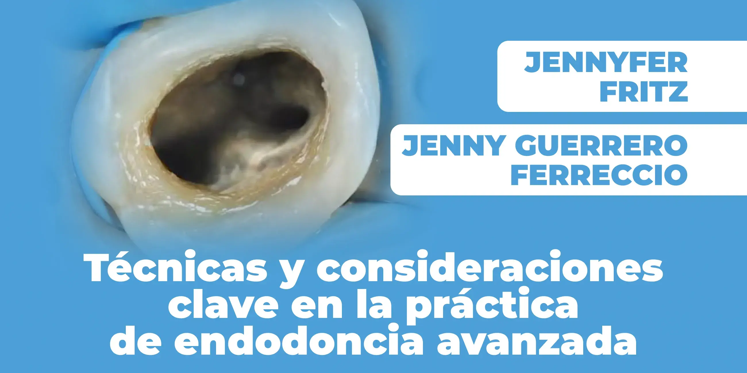 Endodoncia y reconstrucción de un diente con caries extensa e infección