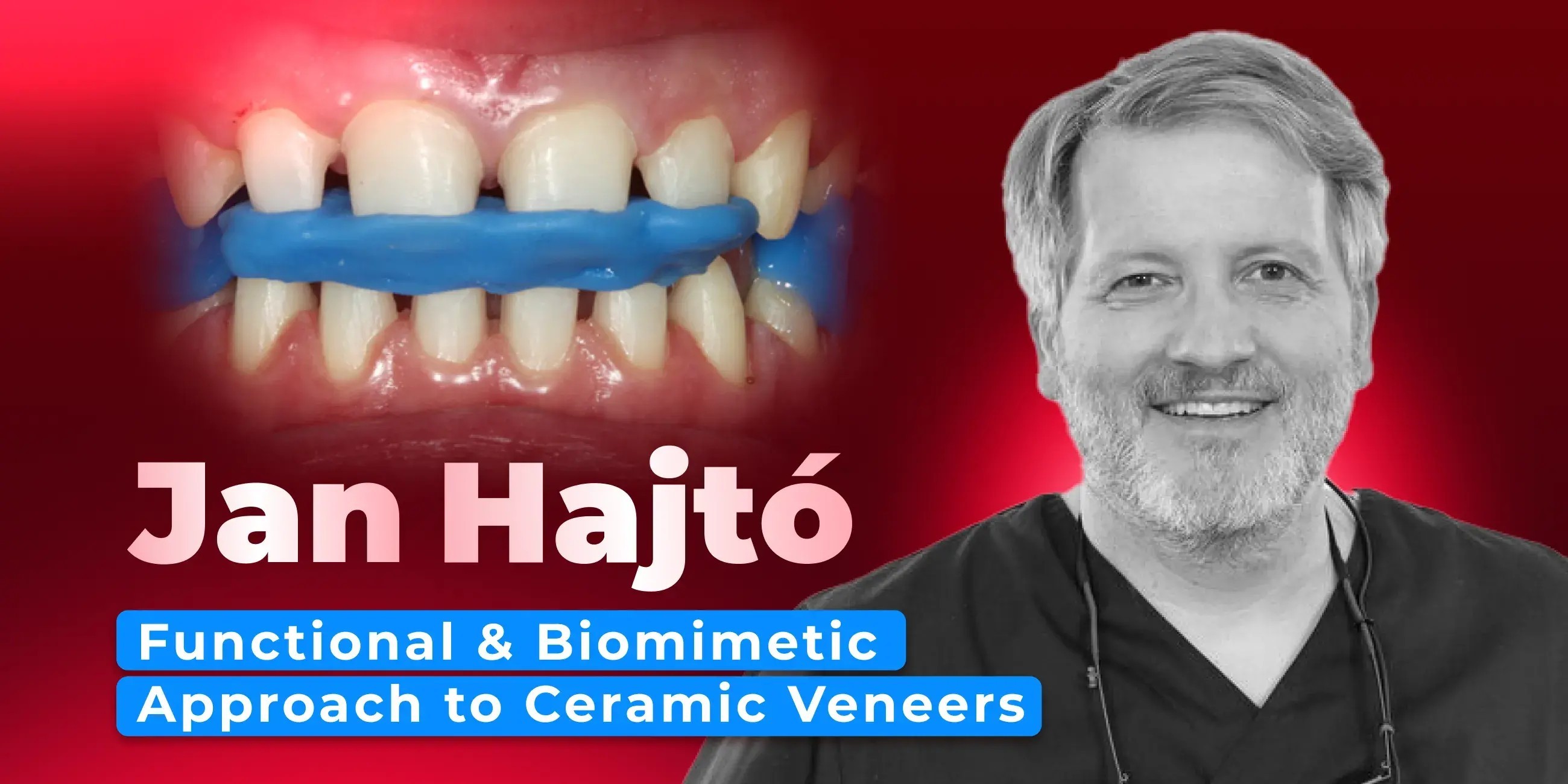 Veneers in Clinical Aesthetic Practice
