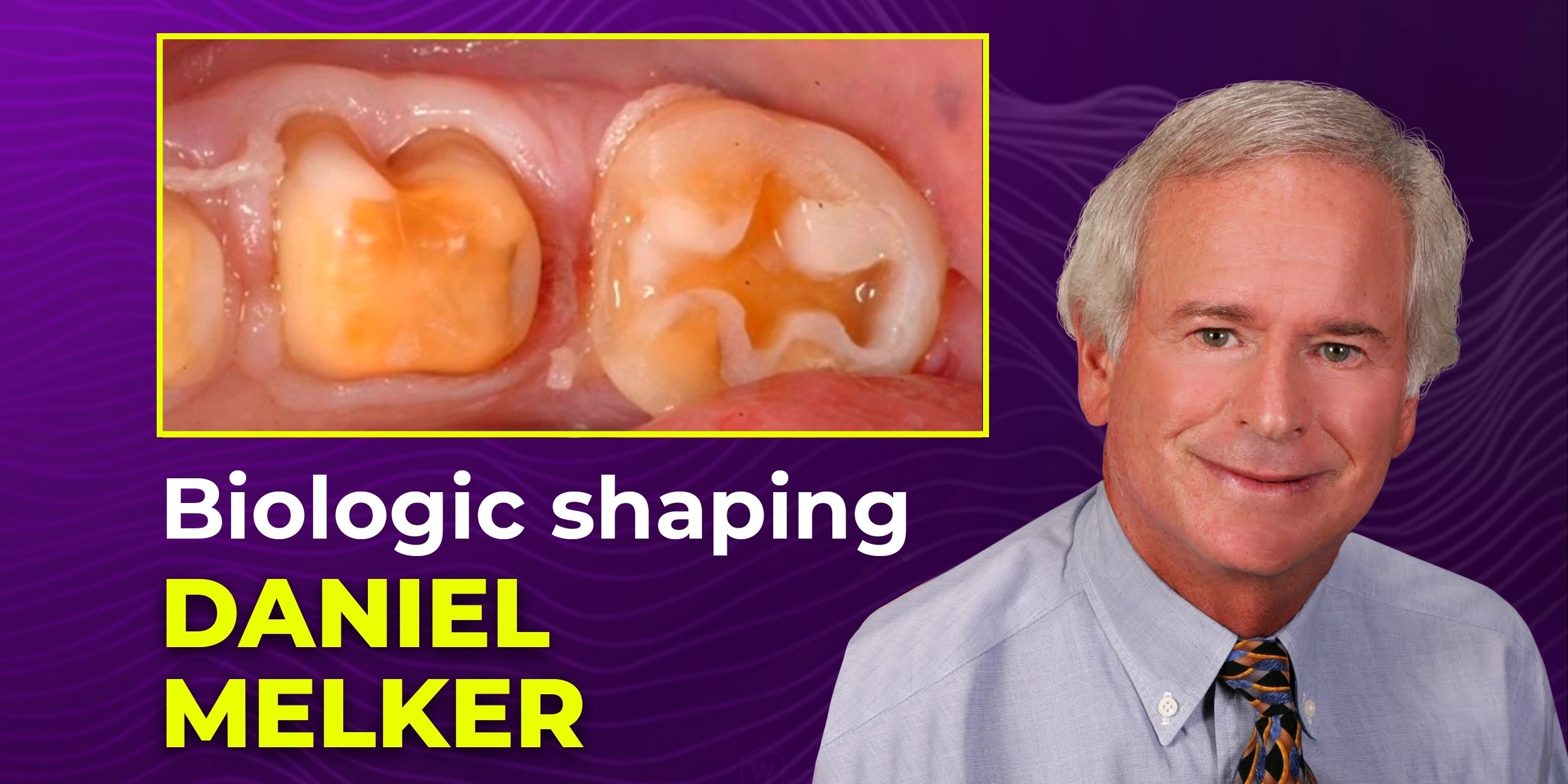 Biologic Shaping: a conservative alternative to crown lengthening