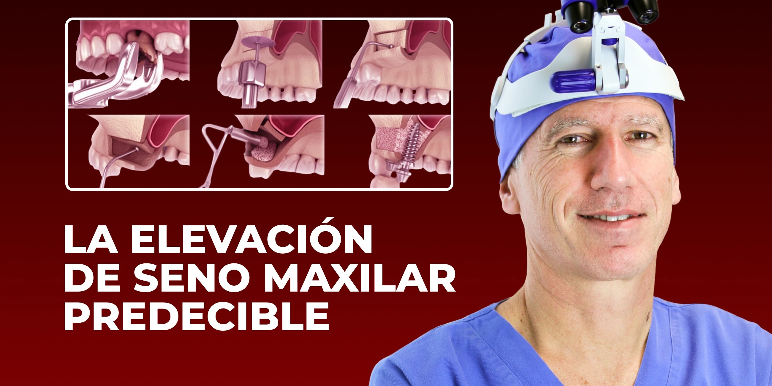 Curso online sobre la elevación de seno maxilar predecible