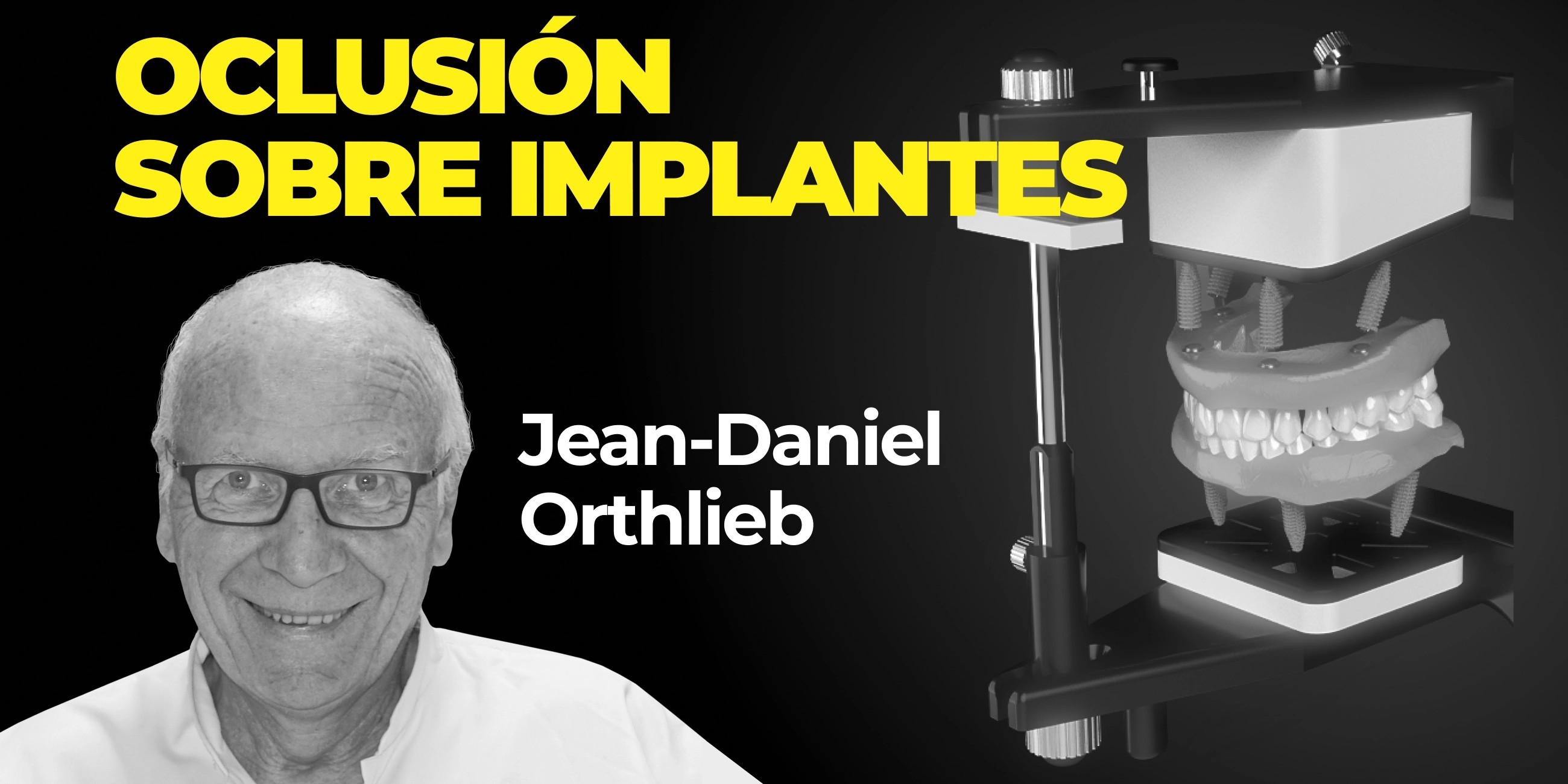Rehabilitación sobre implantes con adentia completa y parcial