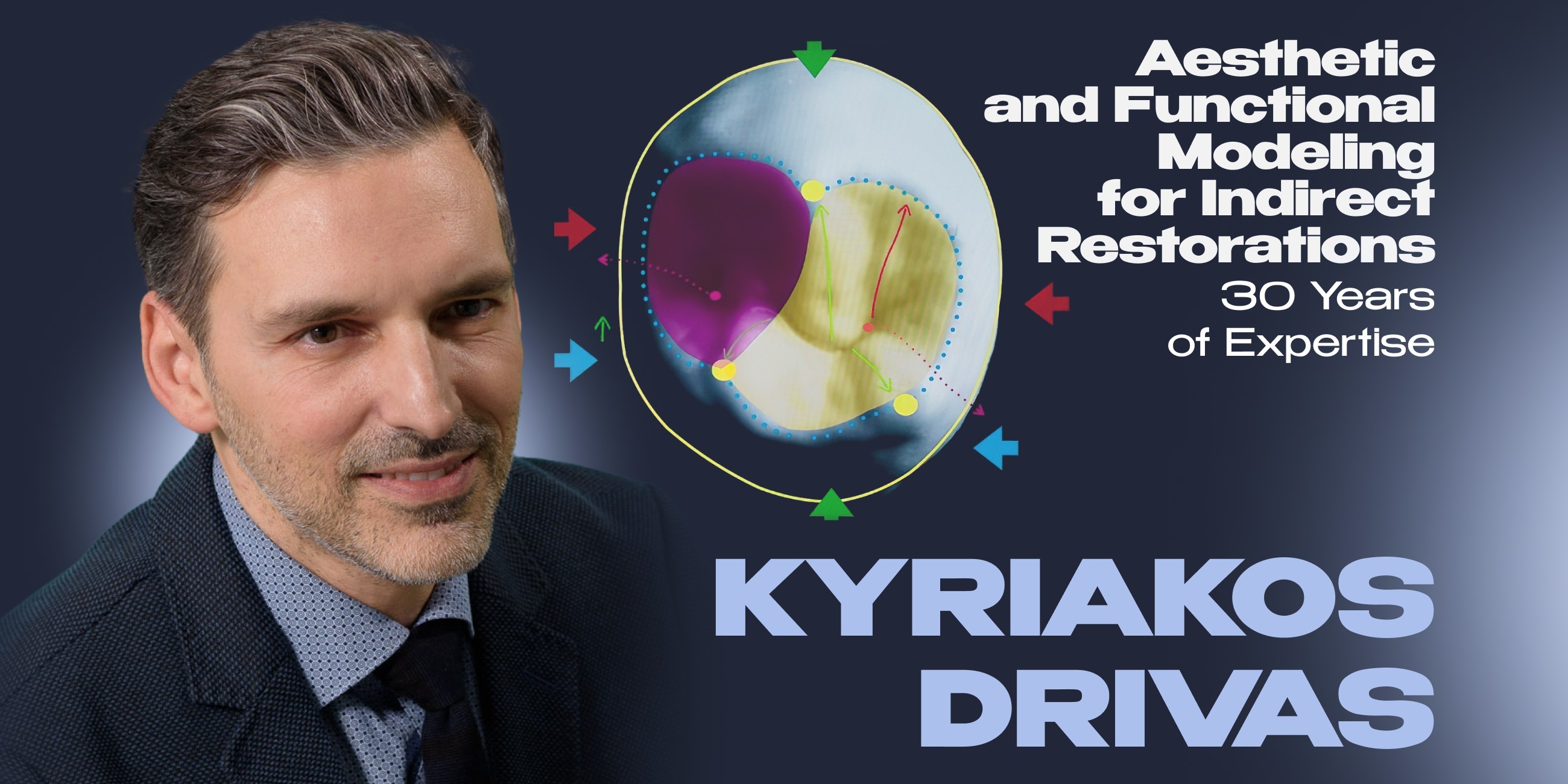 Achieving Natural Aesthetics in Upper Anterior Teeth