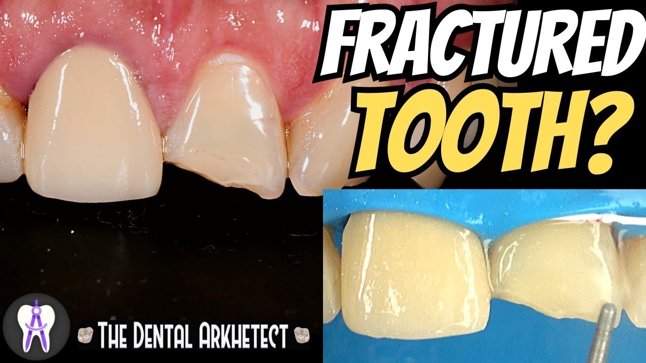 Quick Restoration of A Fractured Tooth