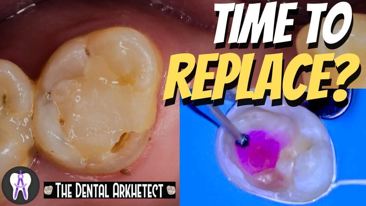 MESMERIZING Restoration of A Big Leaky Old Tooth Filling Using Electric ...