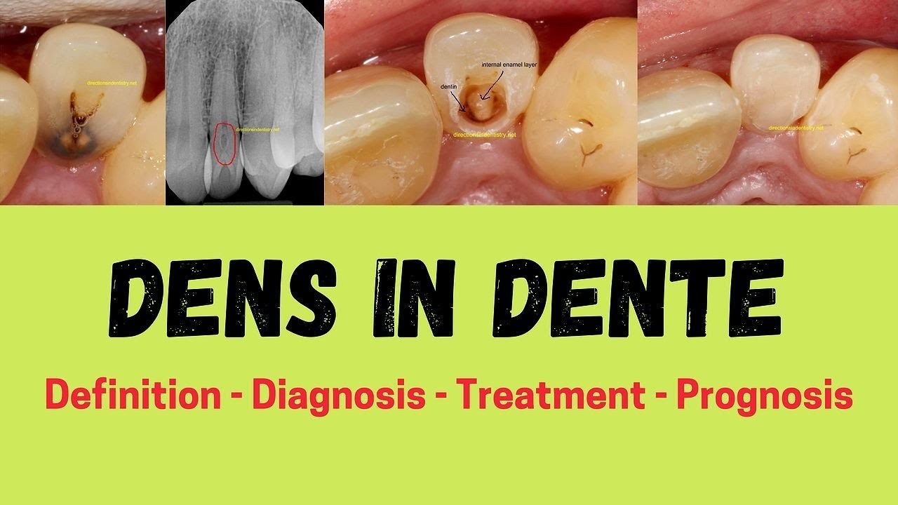 Dens In Dente - Dens en Dente or Dens Invaginatus - “Tooth Within a Tooth”