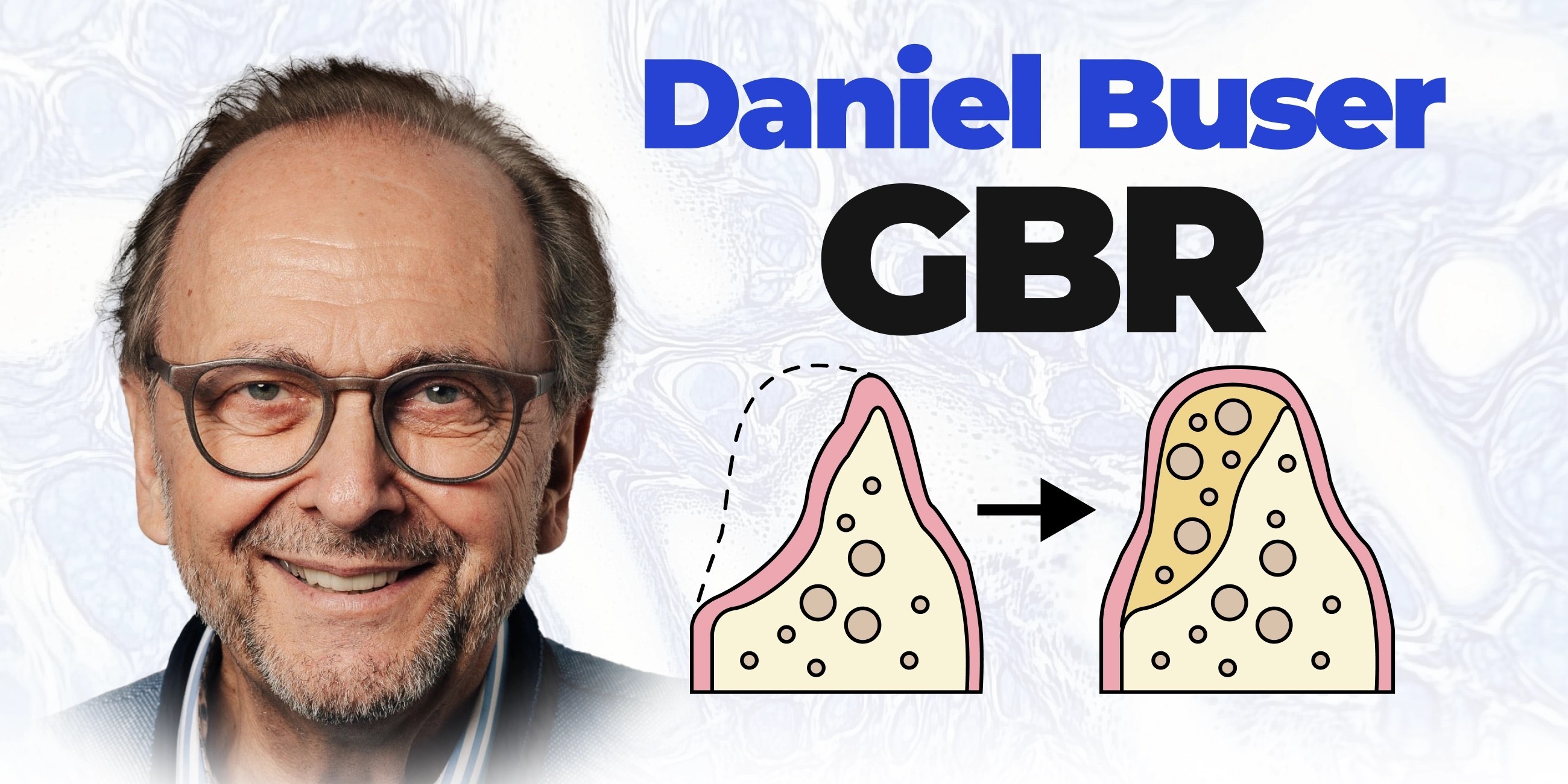 Guided Bone Regeneration (GBR) with Prof Dr Daniel Buser – Online CE Course