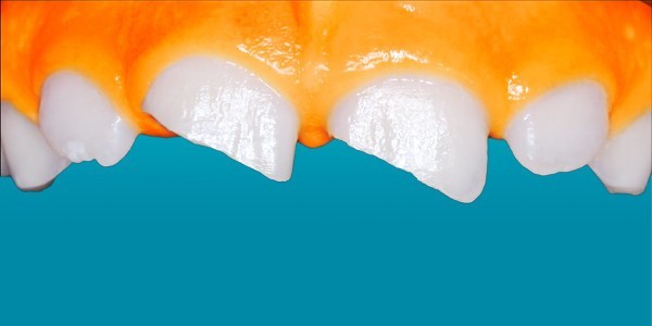 Pediatric Dentistry Evolution 2.0: Vital pulp therapy of temporary teeth