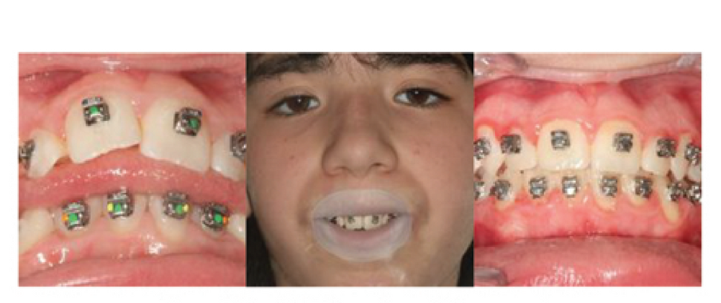The Importance of Correct Swallowing Technique in Orthodontics