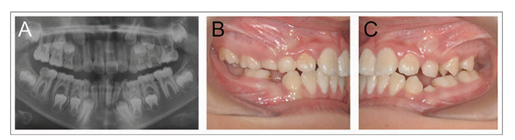 First Permanent Molar Extraction in Children: Updated Guidelines