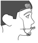 Chin Cup, Face Mask & Headgear: Orthopedic Traction in Orthodontics