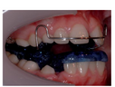 Functional Appliances in Orthodontics: Evidence, Timing, and Limits
