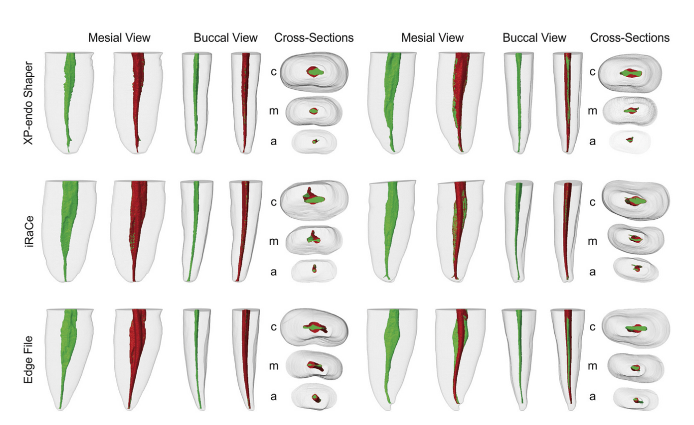 Comparative Study of XP-endo Shaper, iRaCe, and EdgeFile Systems Using ...