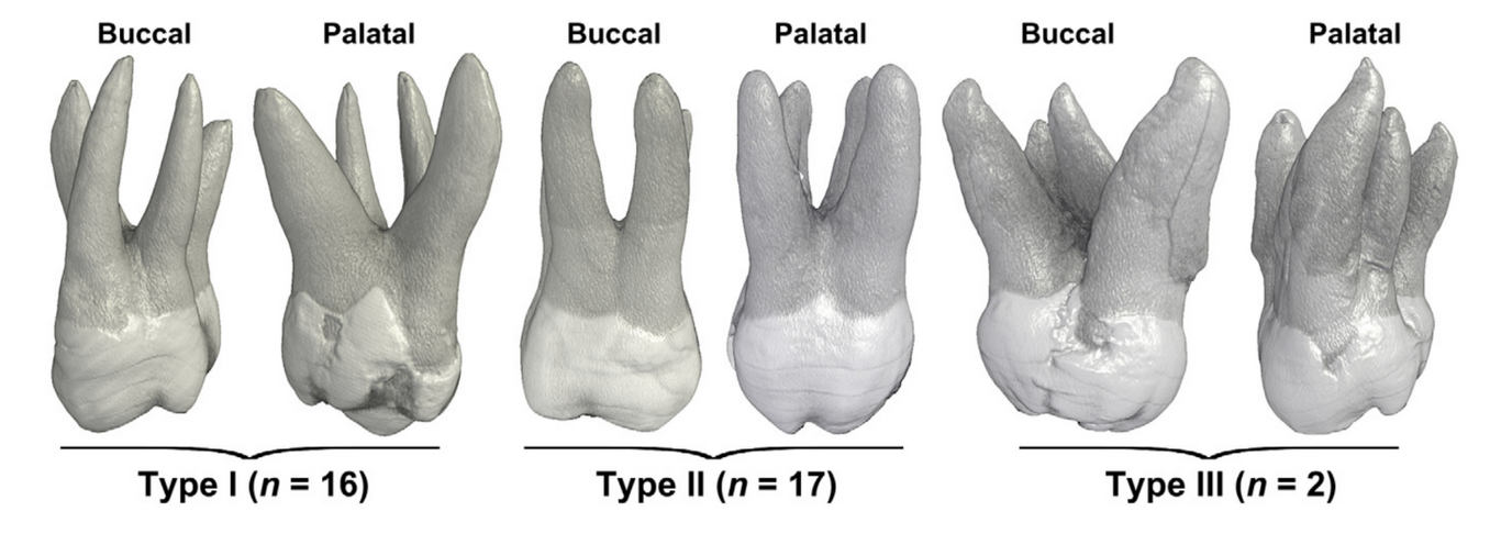 Study on the Anatomy of 4-Rooted Maxillary Second Molars Using Micro ...