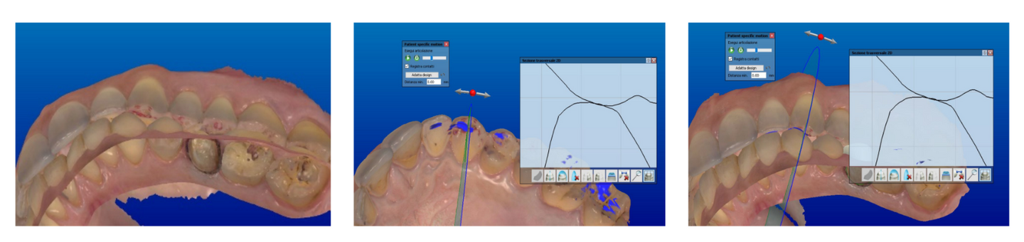 Efficacy of Digital Protocols in Occlusal Analysis for Prosthodontics