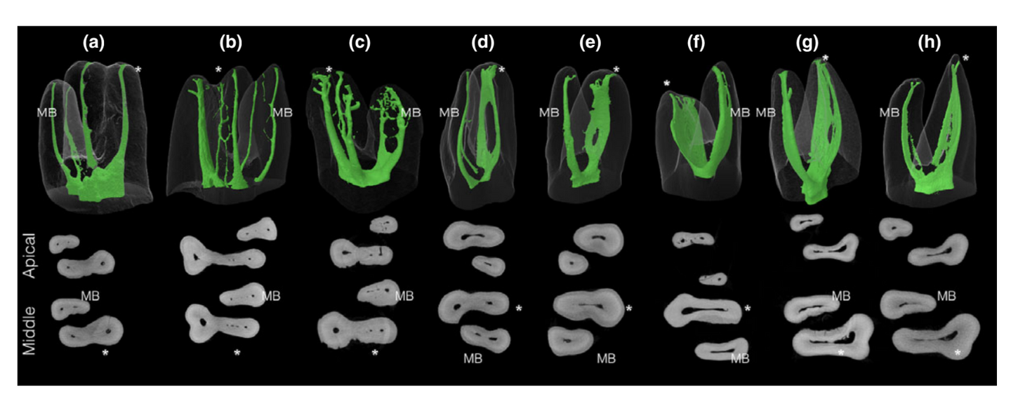 Analysis of Fused-Rooted Maxillary Second Molars Using Micro-CT
