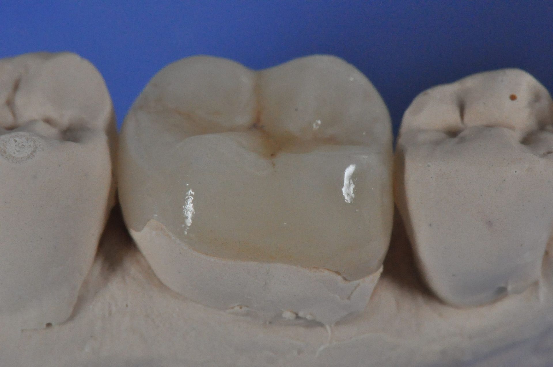 Cervical Margin Displacement