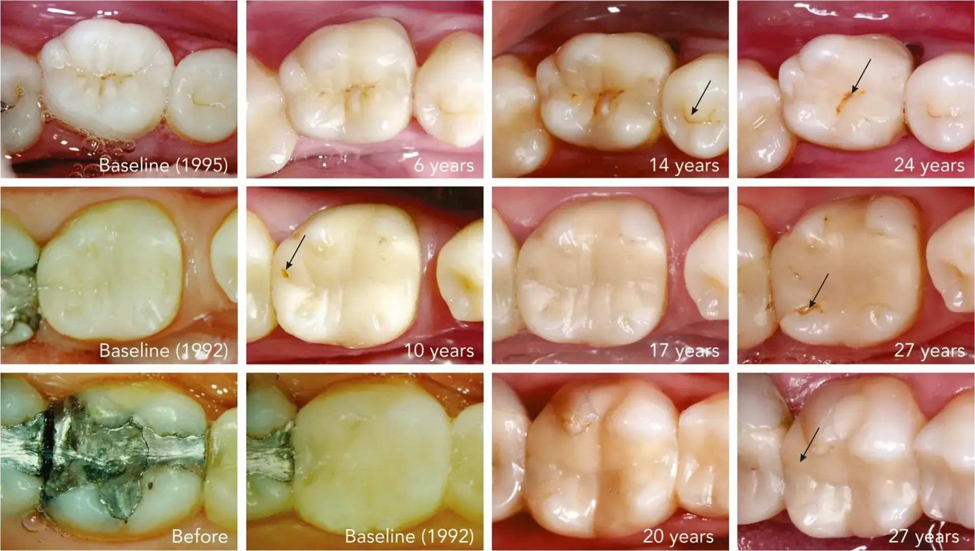 Clinical performance of direct resin composite restorations