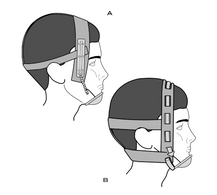 Orthopedic Traction in Orthodontics: Facemasks, Chin Cups, Headgear