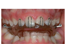 Functional Appliances in Orthodontics: Evidence, Timing, and Limits