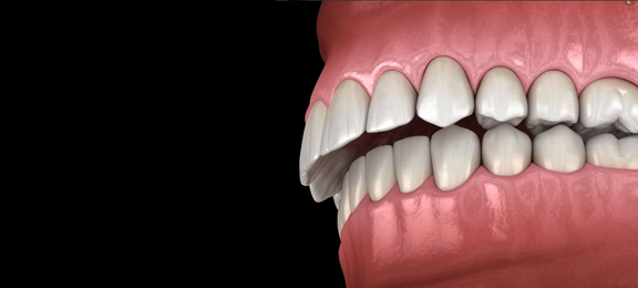 General Characteristics of Deep Bite