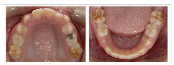 First Permanent Molar Extraction in Children: Updated Guidelines