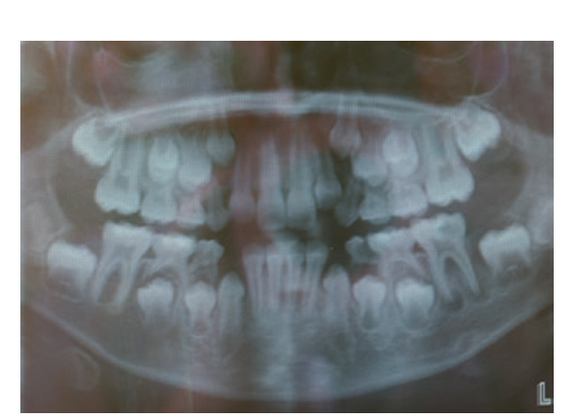 First Permanent Molar Extraction in Children: Updated Guidelines