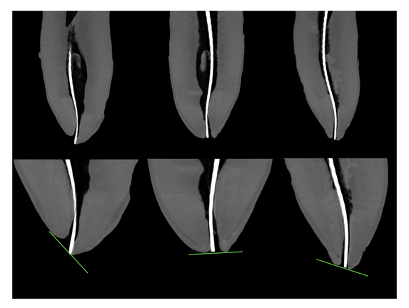 Comparative Study of Wirele-X and RootZX II Apex Locators