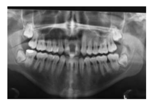 Missing Central Incisor: Treatment Options and Orthodontic Space Closure