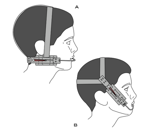 Chin Cup, Face Mask & Headgear: Orthopedic Traction in Orthodontics