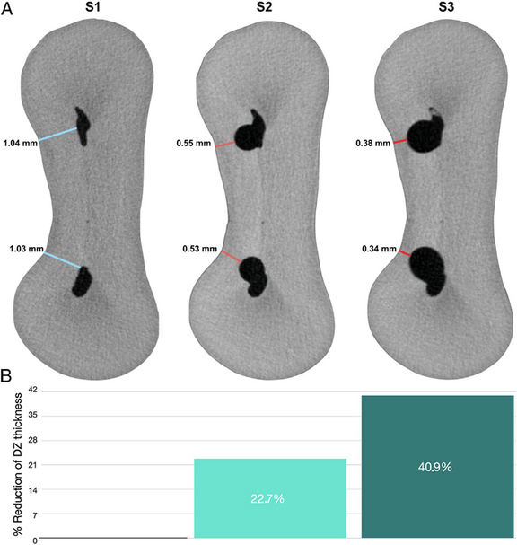 Study on the Impact of Root Canal Enlargement on the Danger Zone of ...