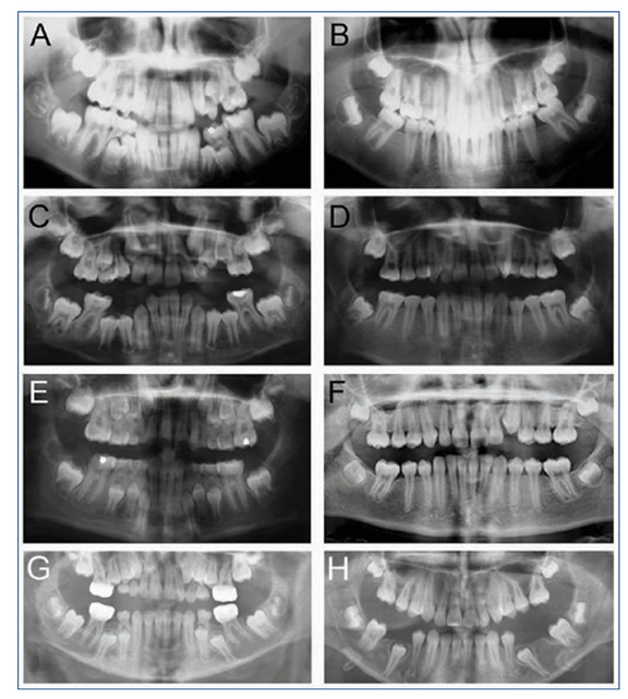 First Permanent Molar Extraction in Children: Updated Guidelines
