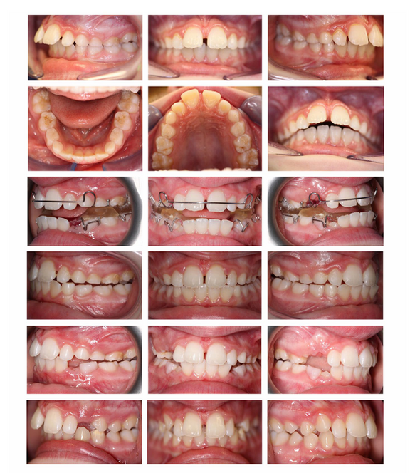 Association Between Overjet and Maxillary Incisor Trauma in Children