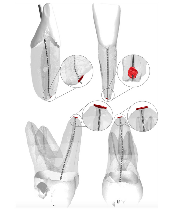 Comparative Study of Wirele-X and RootZX II Apex Locators
