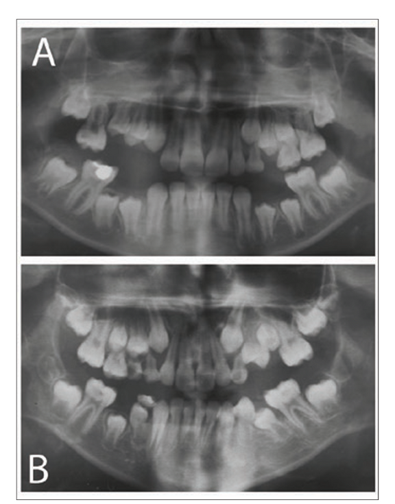 First Permanent Molar Extraction in Children: Updated Guidelines