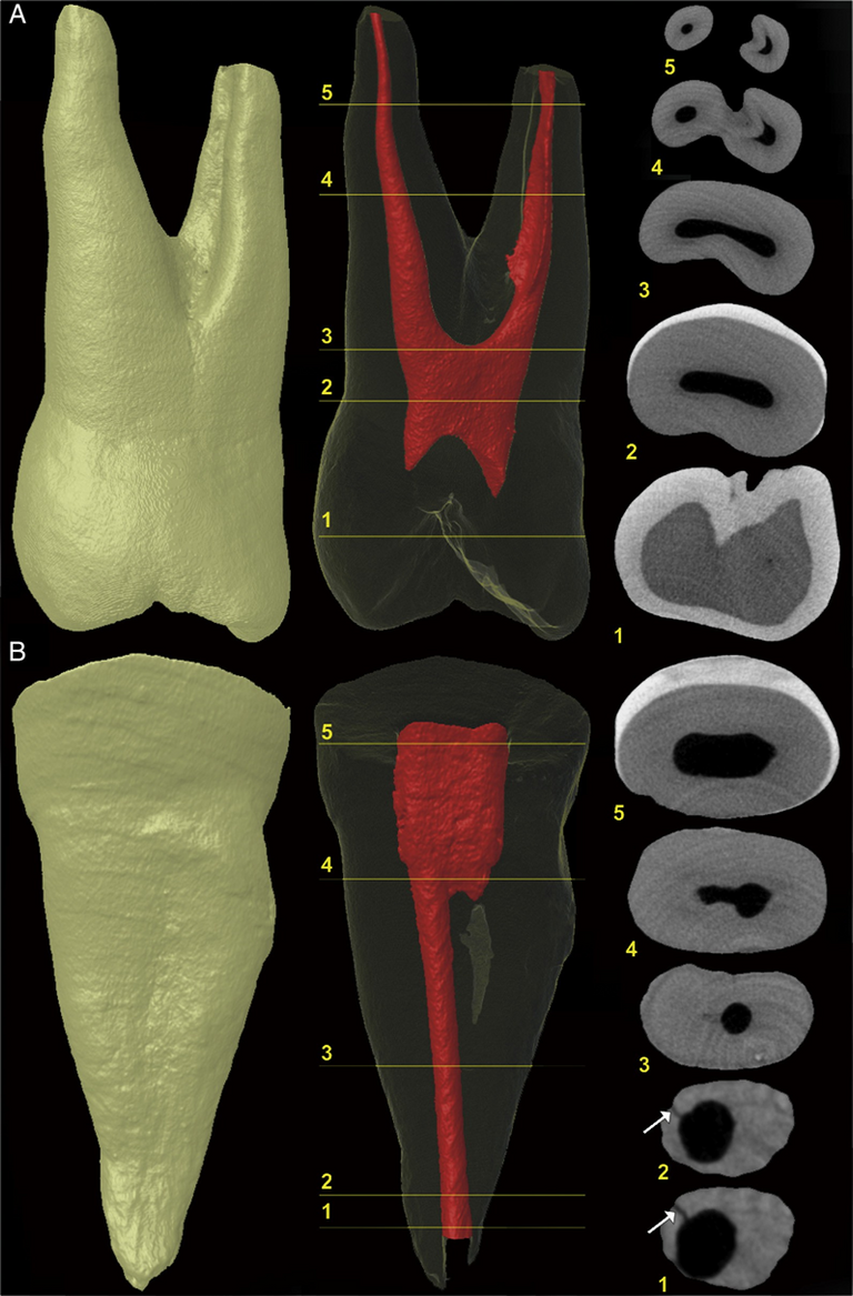Study on Dentinal Microcracks in Premolars After Root Canal Preparation