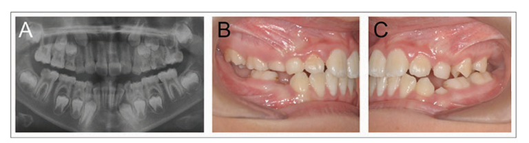 First Permanent Molar Extraction in Children: Updated Guidelines