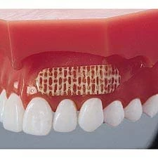 Dentipatch Lidocaine Transoral Delivery System, Self-Adhesive, 3cm x ...